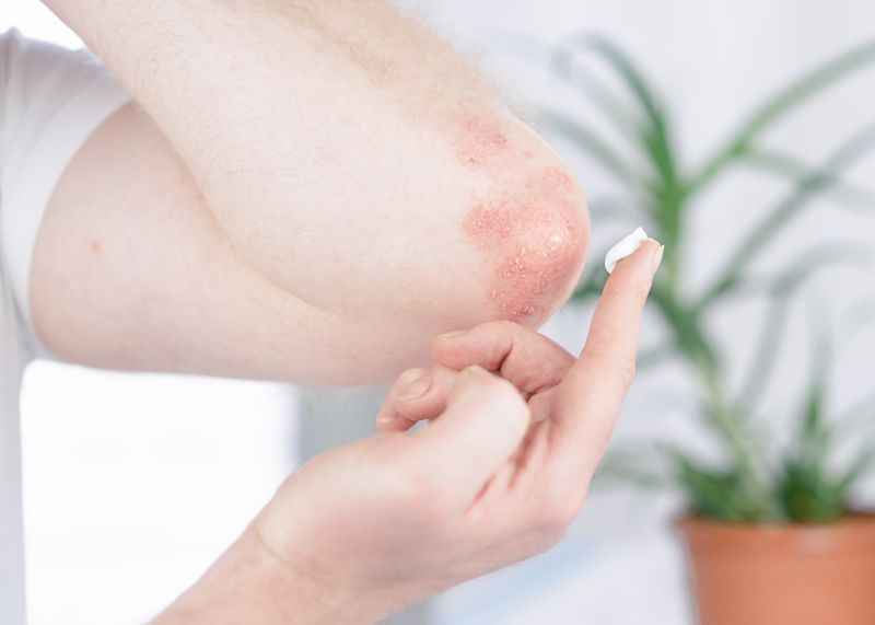 Neurodermatitis Treatment Guide - RemoteDerm