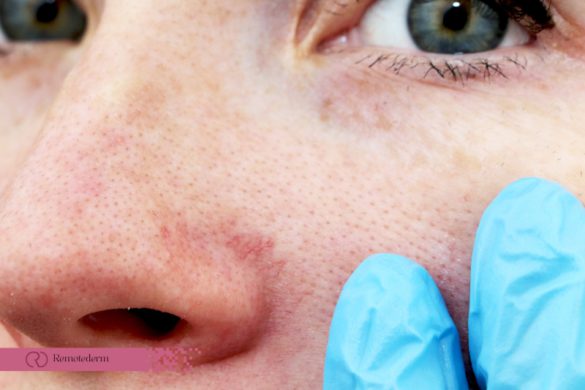 Rosacea Relief: Tips, Treatments, and Expert Insights