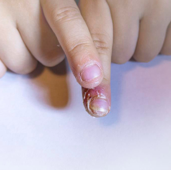 Caring for the Proximal Nail Fold - RemoteDerm