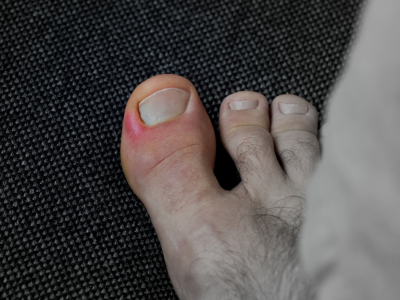 How To Treat Paronychia - RemoteDerm