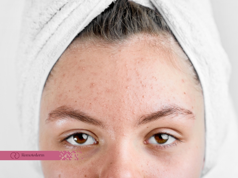 Understanding Steroid Acne - RemoteDerm