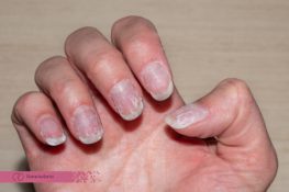 Nail Diseases Chart: Picture, Sign and Treatment