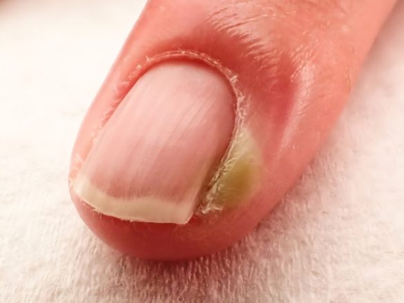 How To Treat Paronychia - RemoteDerm