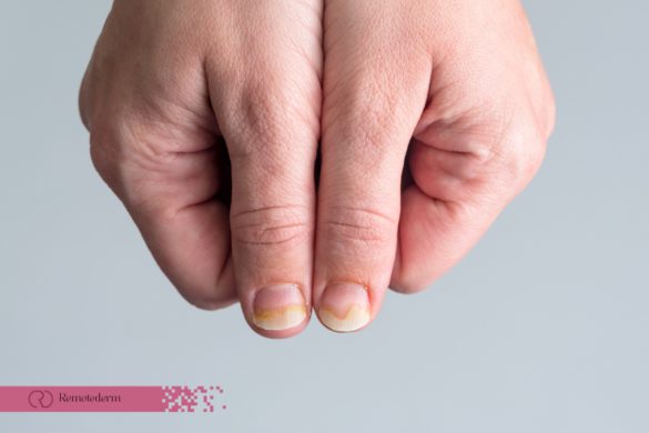 Nail Diseases Chart: Picture, Sign and Treatment