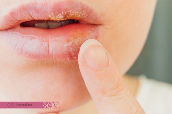 skin cancer types, Treatments and more about skin cancer rash