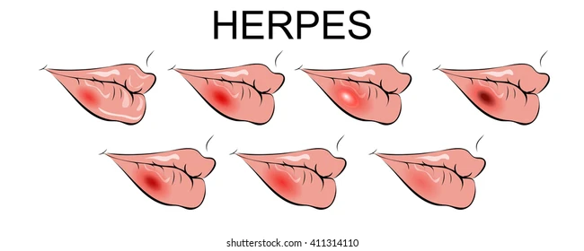 Understanding Cold Sore Stages - RemoteDerm