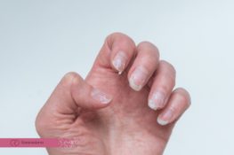 Nail Diseases Chart: Picture, Sign and Treatment