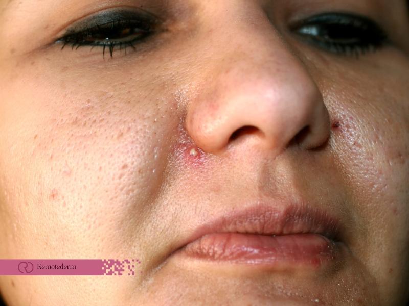 How to Treat Inflamed Acne - RemoteDerm
