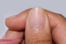 Nail Diseases Chart: Picture, Sign and Treatment