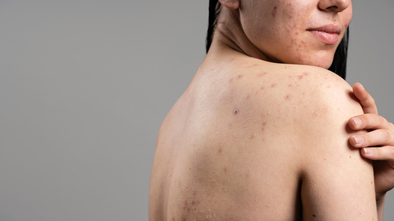 Understanding Steroid Acne - RemoteDerm
