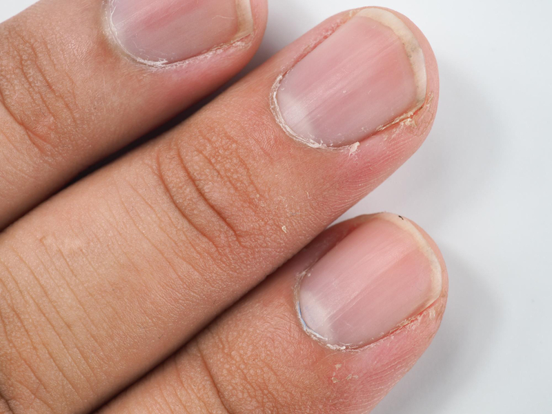What Causes Ridges in Nails? - RemoteDerm
